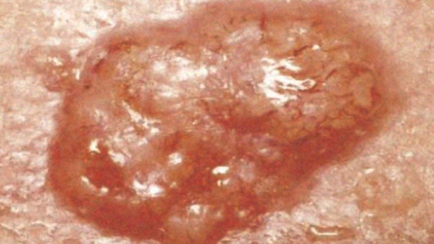 Controlul natural al cancerului de piele